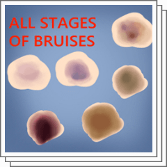 Types of Bruises - CLIP STUDIO ASSETS
